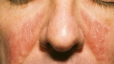 Dermatitis On Forehead